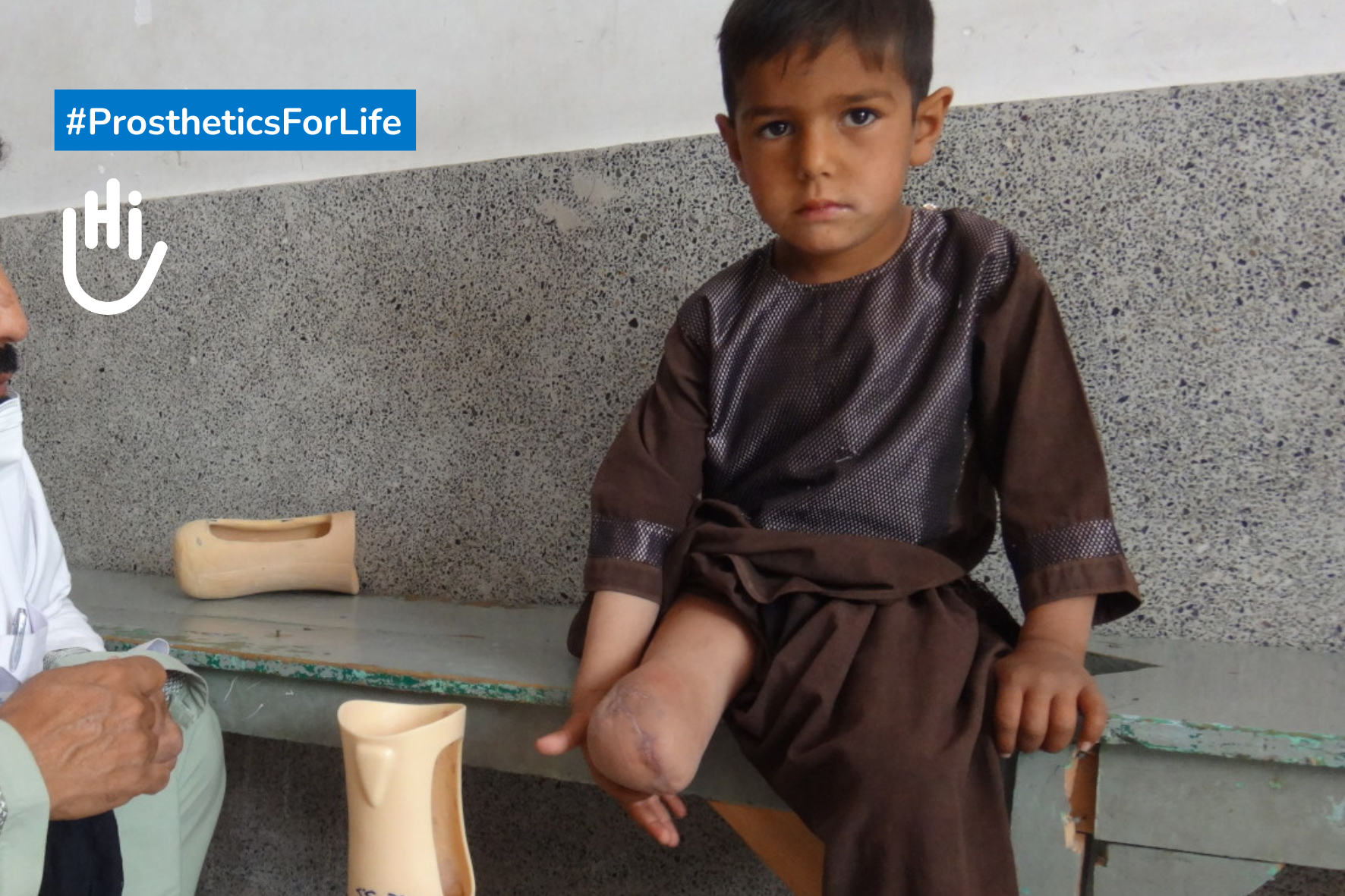 Every child amputee deserves a second chance #ProstheticsForLife ...